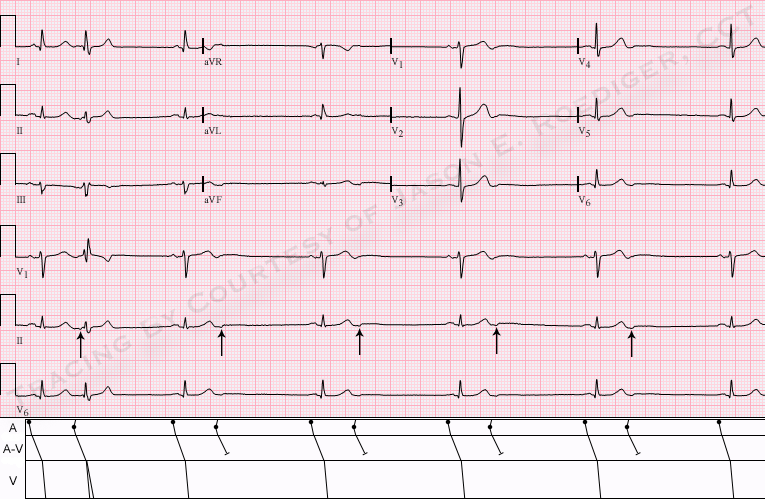 Nonconducted Atrial Bigeminy Ecg Guru Instructor Resources
